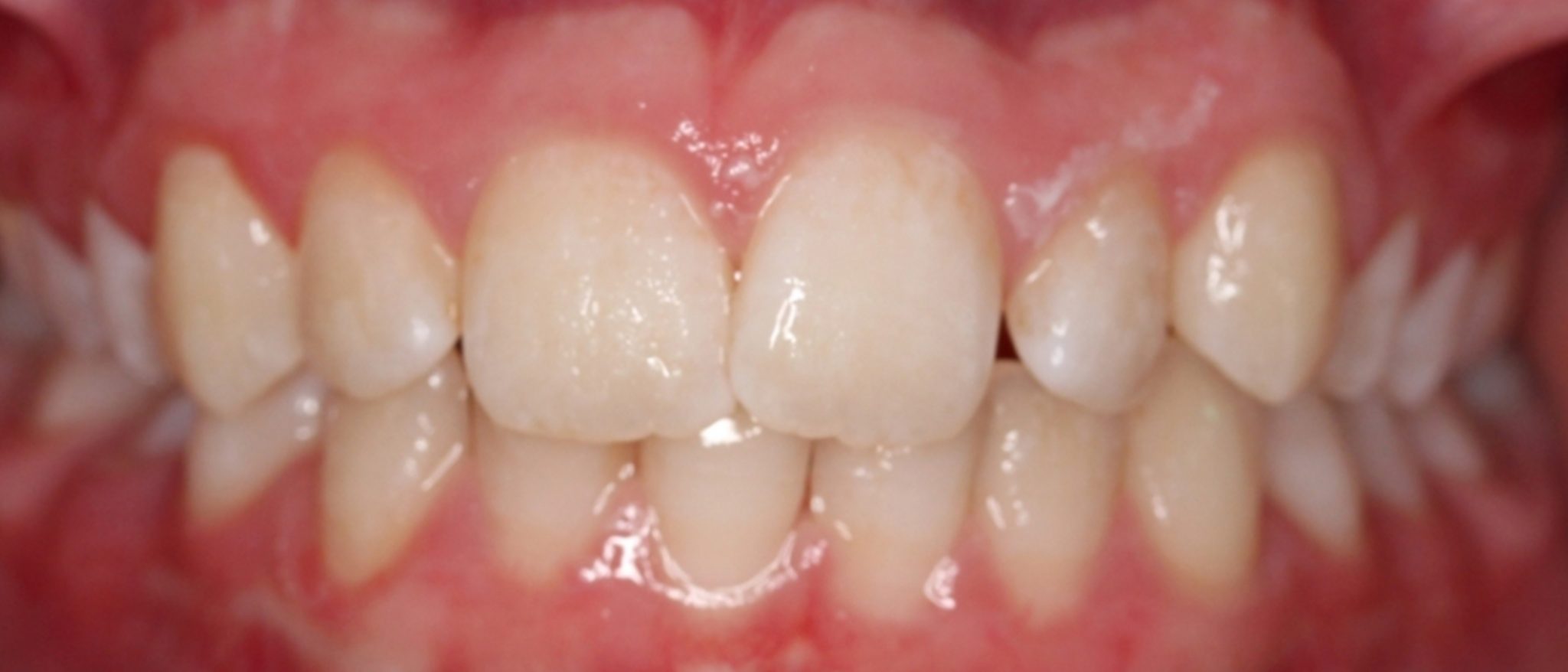 Smile Gallery - Lincoln Orthodontics